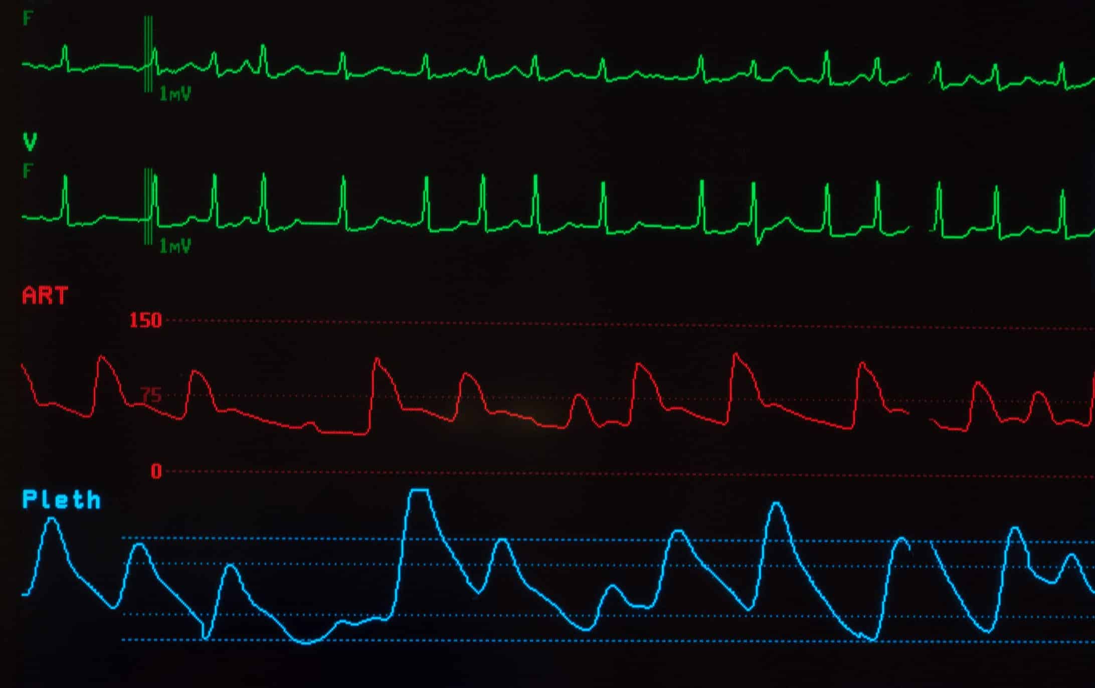 Pulsed Field Ablation Safe for Atrial Fibrillation Patients ...