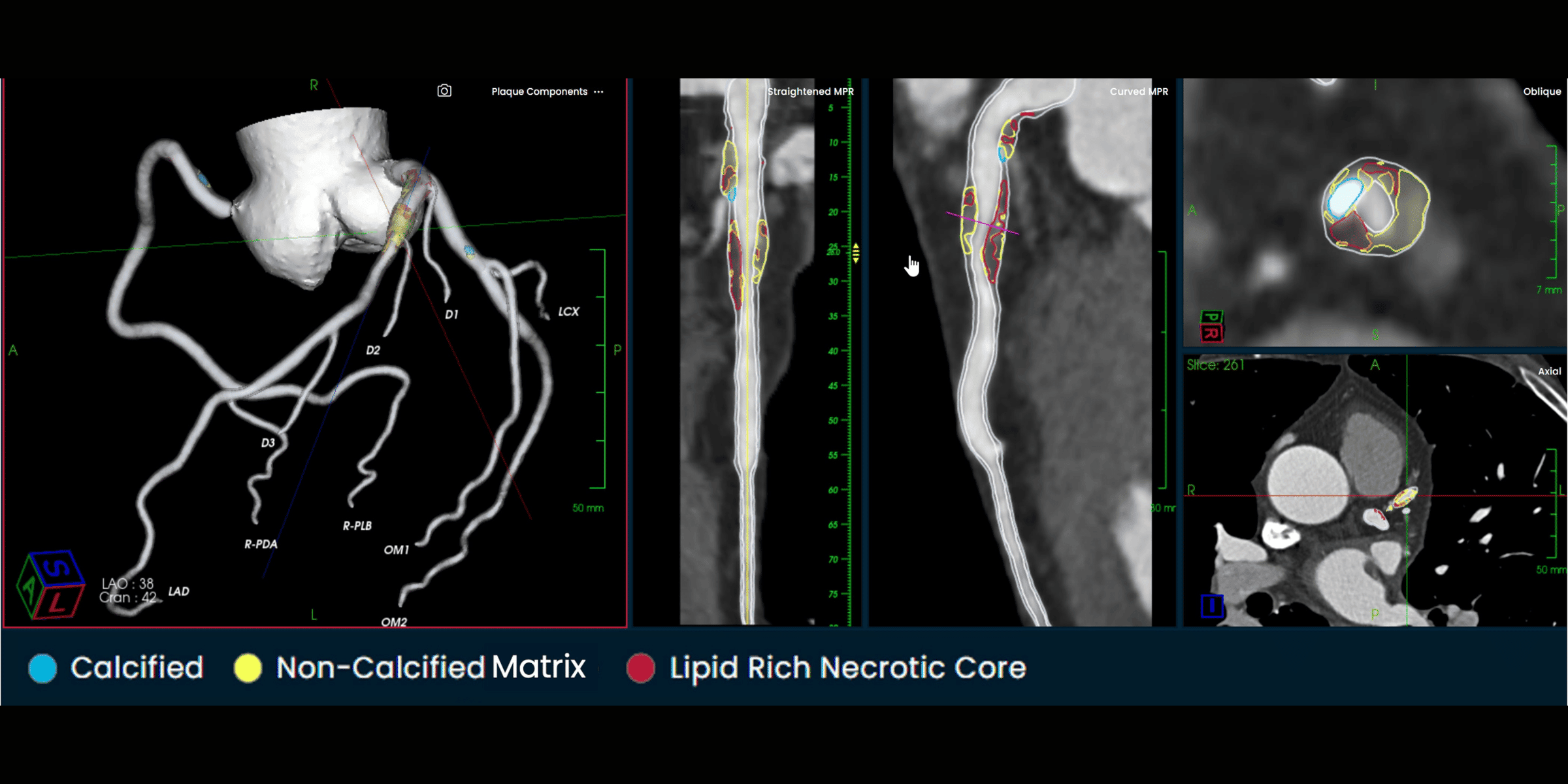 FDA Clears PlaqueIQ to Aid Cardiovascular Disease Assessment